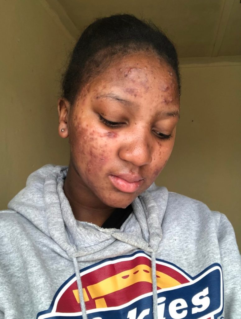 Lady who battled acne, shows off her incredible facial transformation
