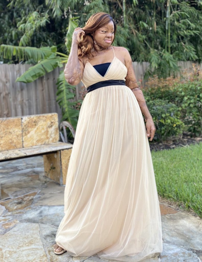 Plane crash survivor, Kechi Okwuchi, celebrates 31st birthday (Video)