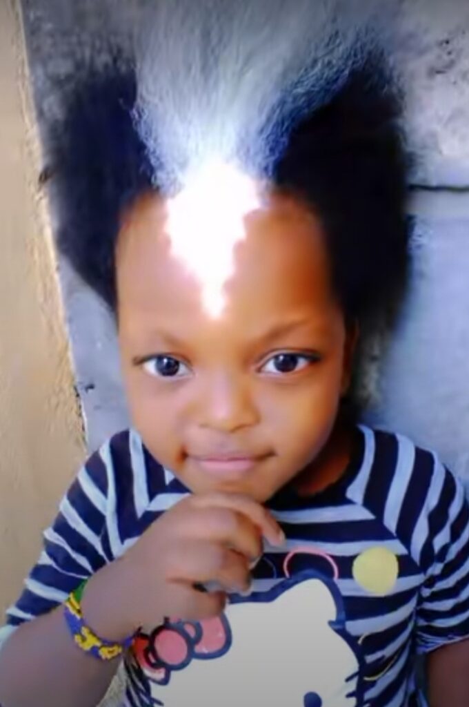 Little girl with shiny birthmark and white frontal hairs stirs reactions