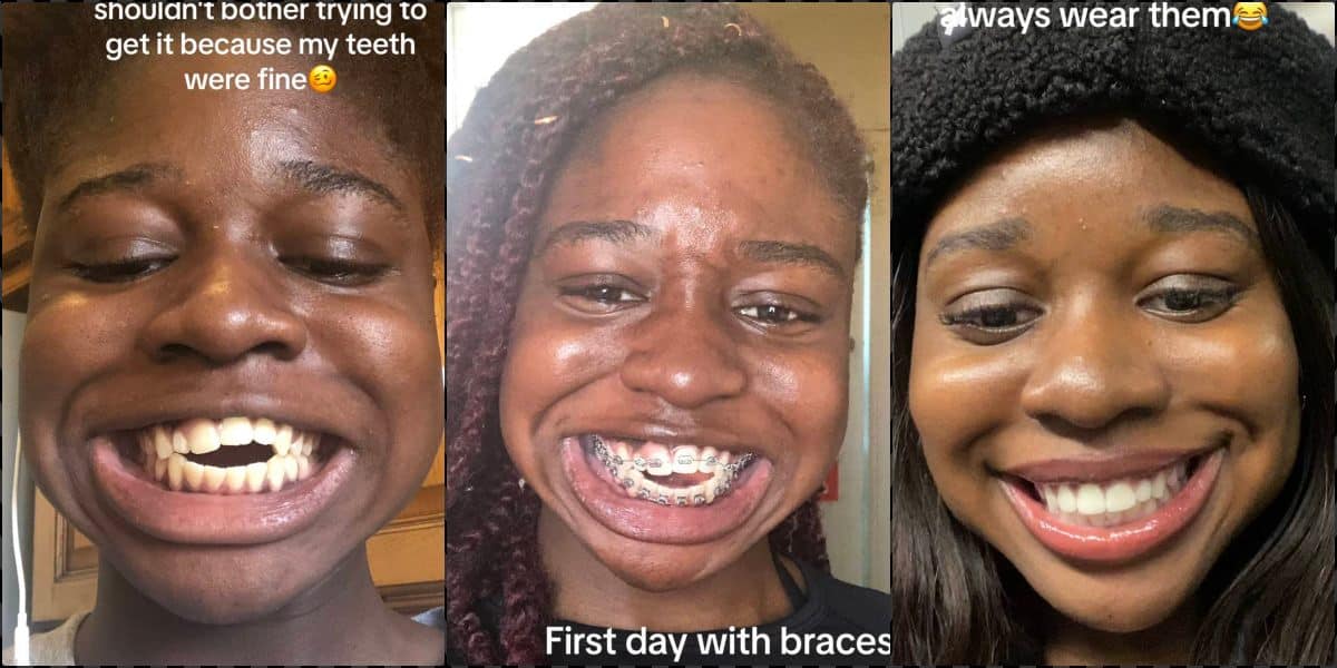 Lady shares beautiful result after wearing braces for five years