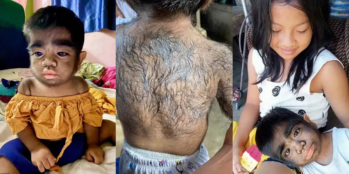 Mother fears son's 'werewolf syndrome' due to eating cat in pregnancy
