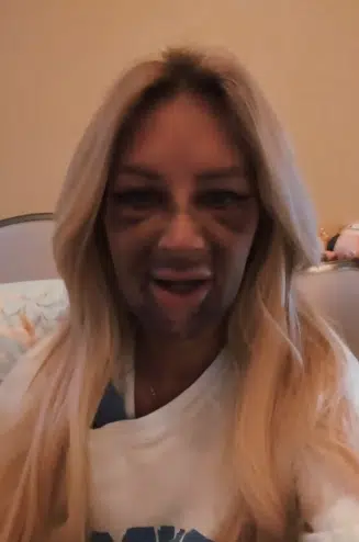 Lady who underwent dental implant cries out over her new look